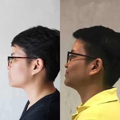 CO2 LASER | INFINITY CLINIC